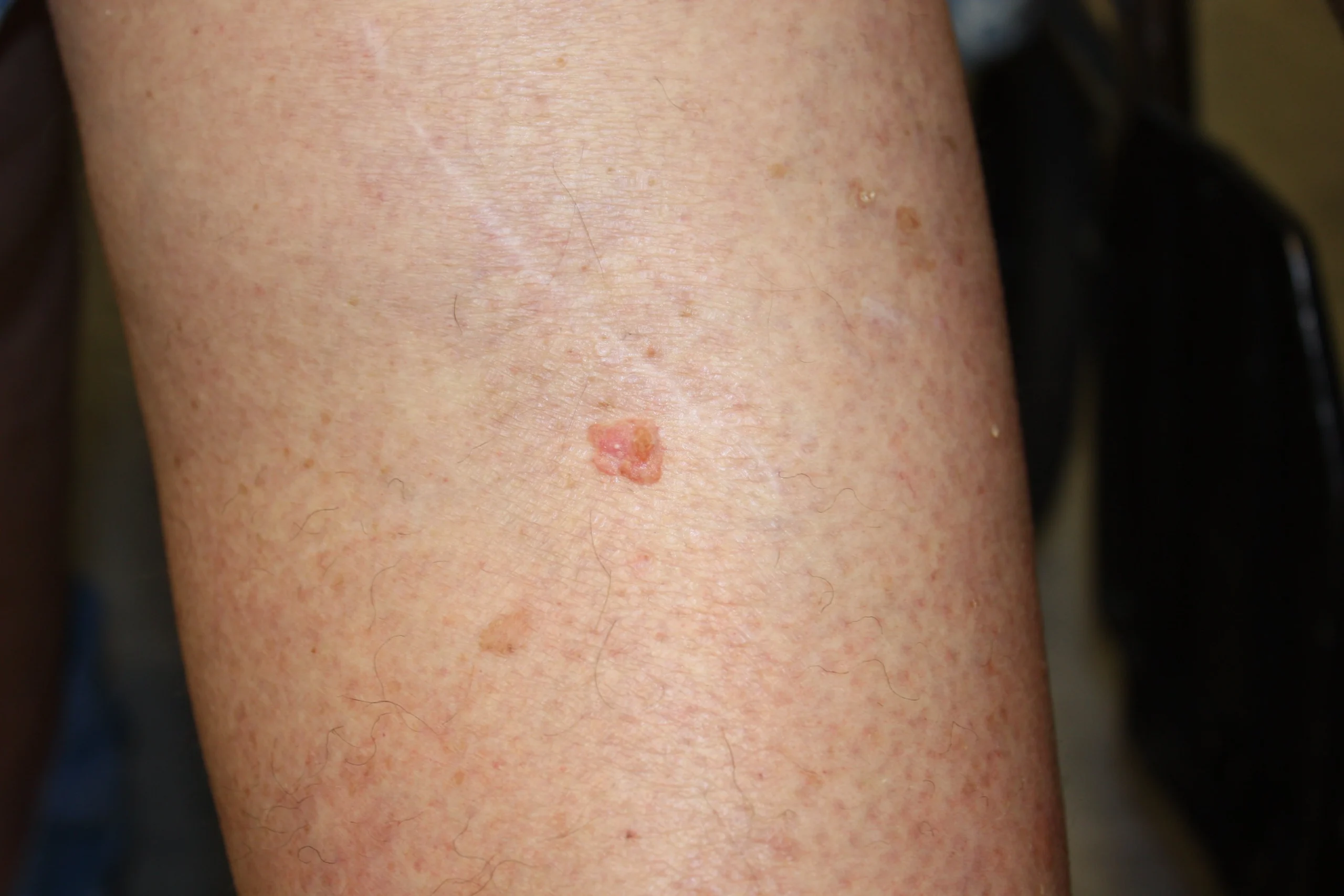 Squamous Cell Carcinomas (SCC) - Canberra Skin Cancer Clinic