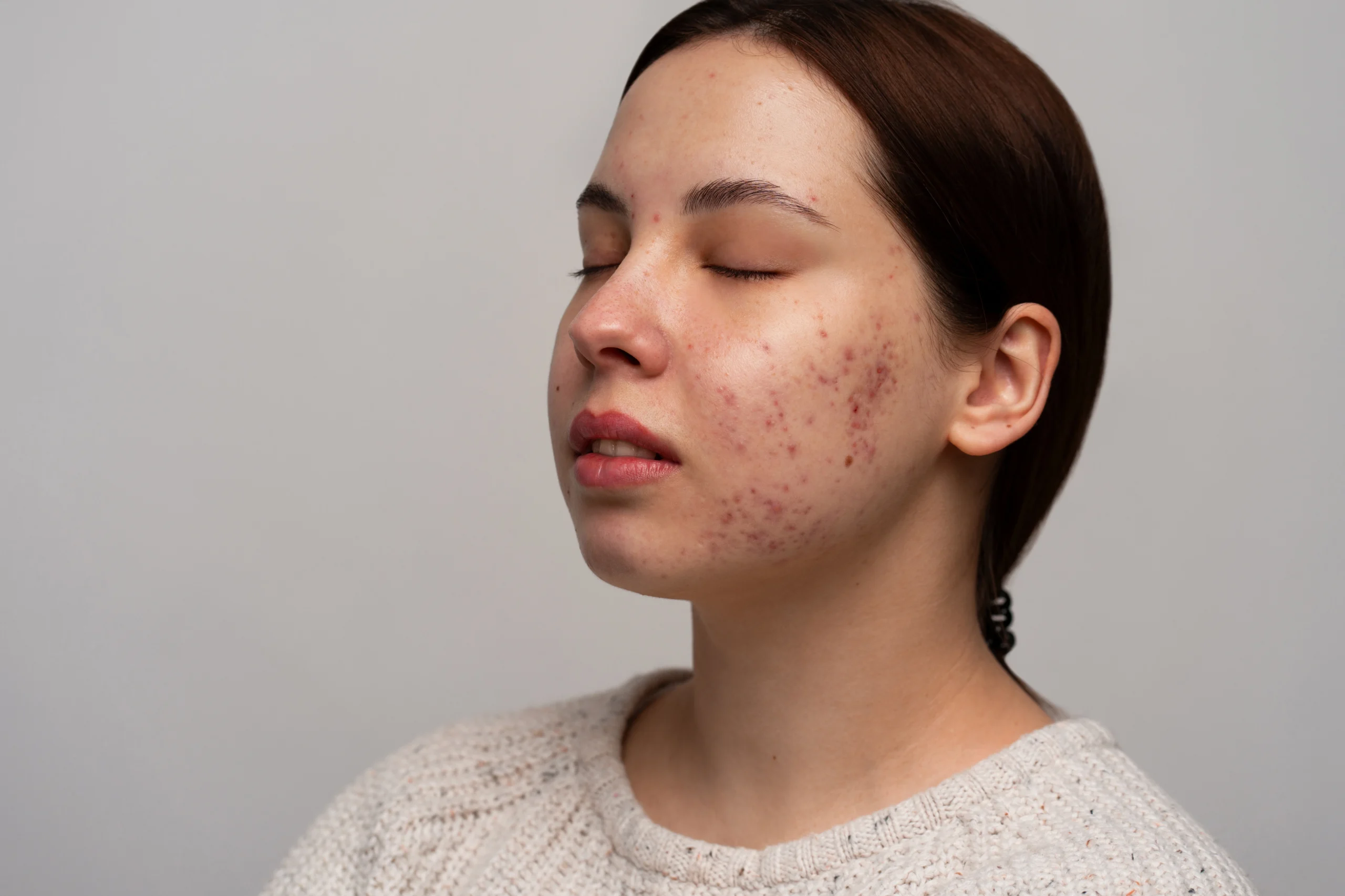 Spots and Blemishes - Canberra Skin Cancer Clinic